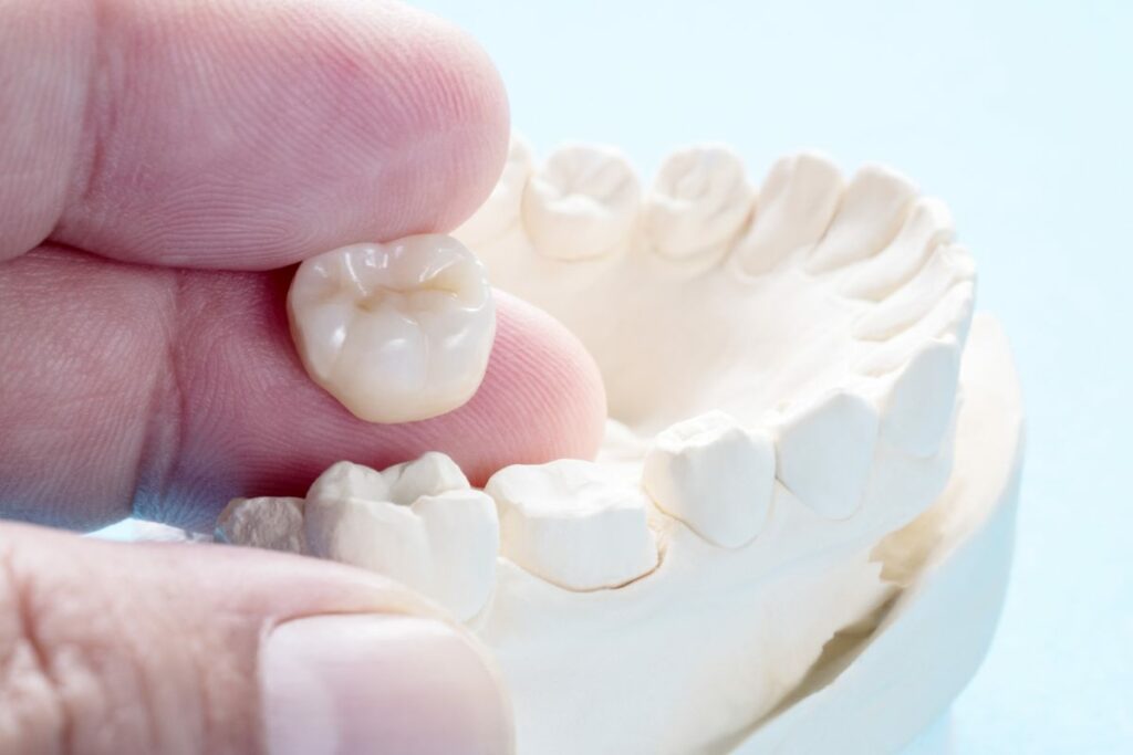 How to Care for Dental Crowns | Baseline Dental Care - Blog